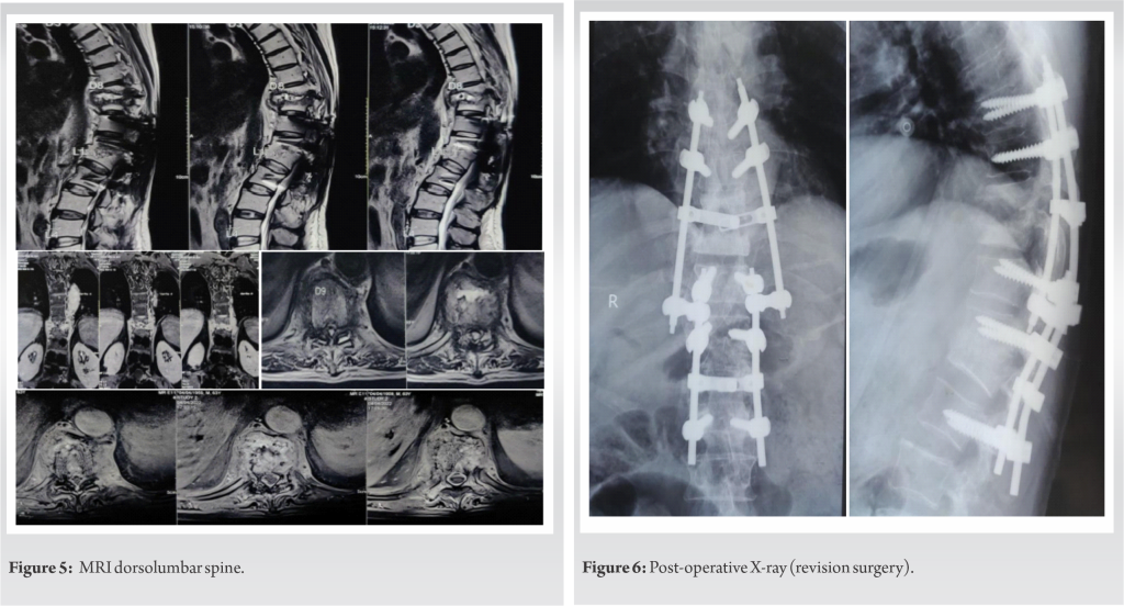Subjacent Disease in an Operated Case of Spinal Tuberculosis: A Case ...