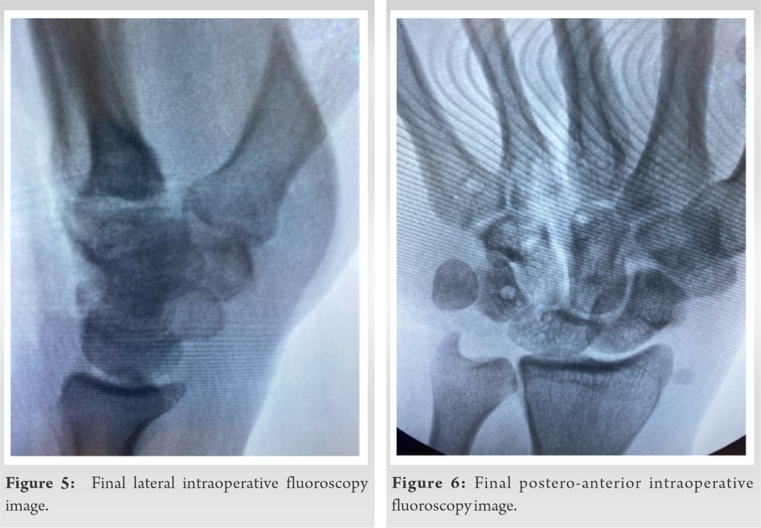 Isolated Hamate Dislocation: A Case Report and Technique Guide | Journal of Orthopaedic Case Reports