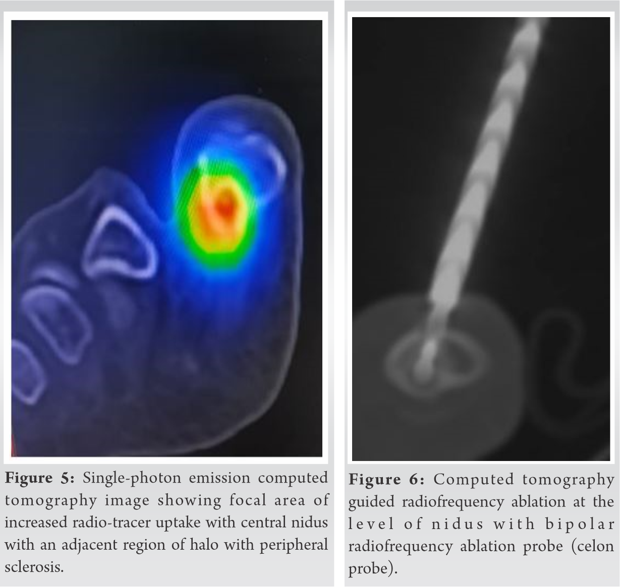 Great Toe Osteoid Osteoma with Atypical Presentation: A Case Report ...
