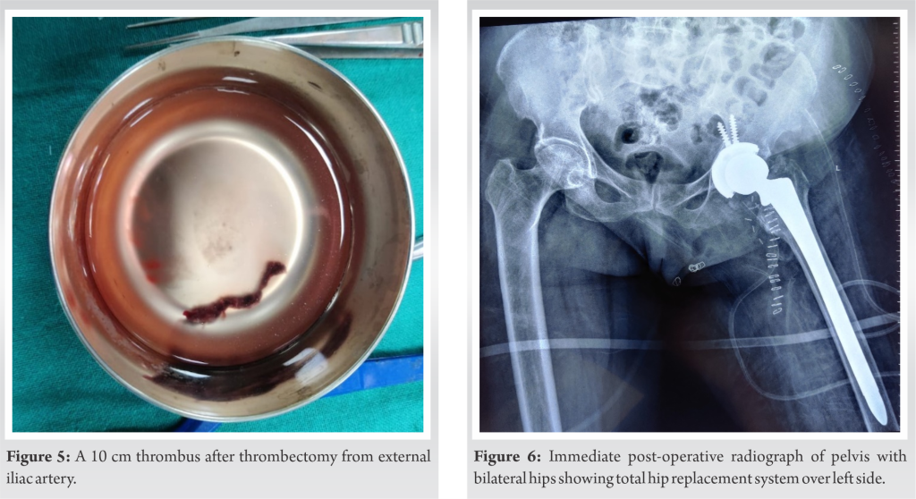 Management of Thrombosis of the External Iliac Artery during Total Hip ...