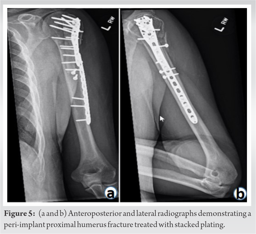 Peri-implant Proximal Humerus Fracture Stabilized with Stacked Plating: A Case Report | Journal ...