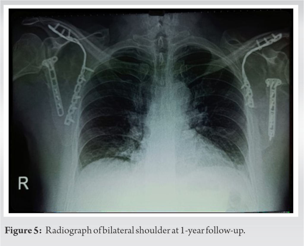 Atraumatic Reciprocal Scapula Fracture – A Case Report and Review of ...