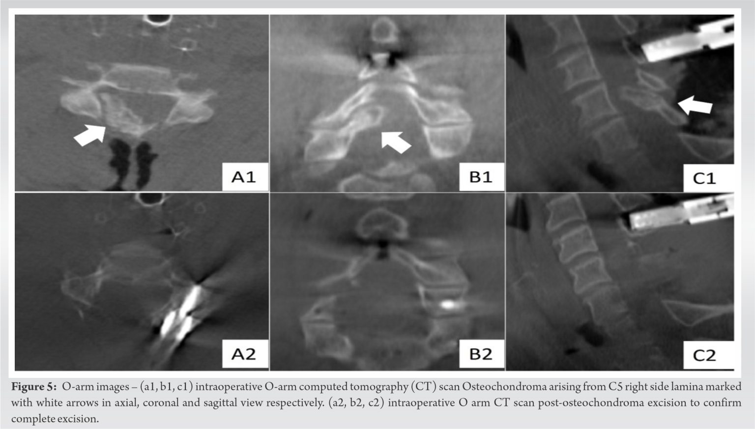 O-arm Navigated en bloc Excision of a Solitary Subaxial Cervical ...