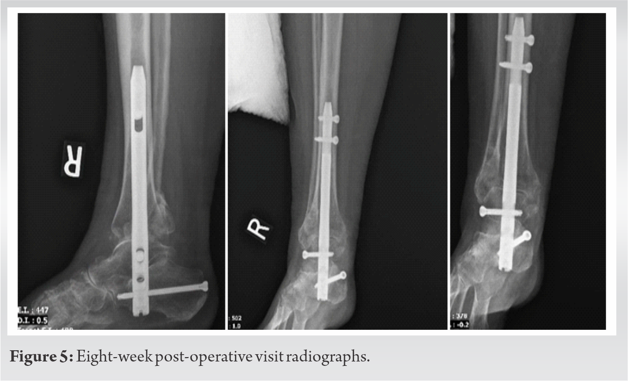 Primary Retrograde Tibiotalocalcaneal Nailing in an Elderly ...