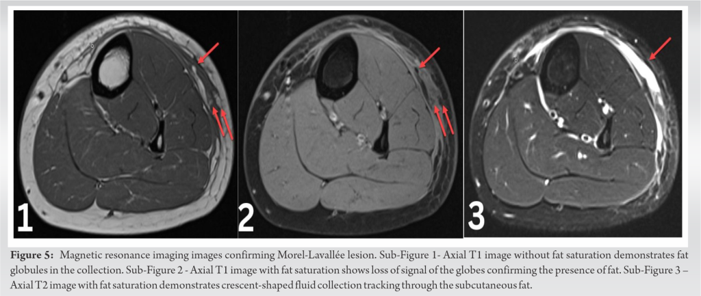 Delayed Onset of Pediatric Morel-Lavallée Lesion: A Case Report ...