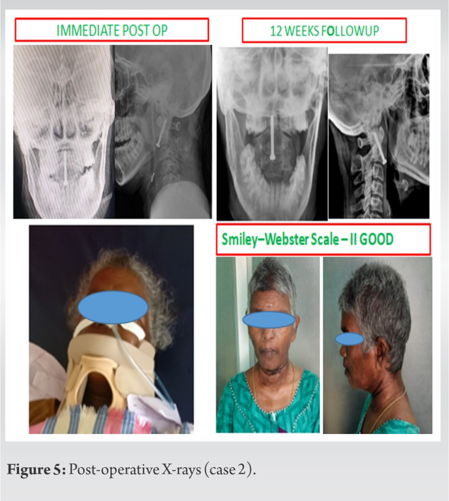 Anterior Screw Fixation for Odontoid Fractures – A Case Series ...