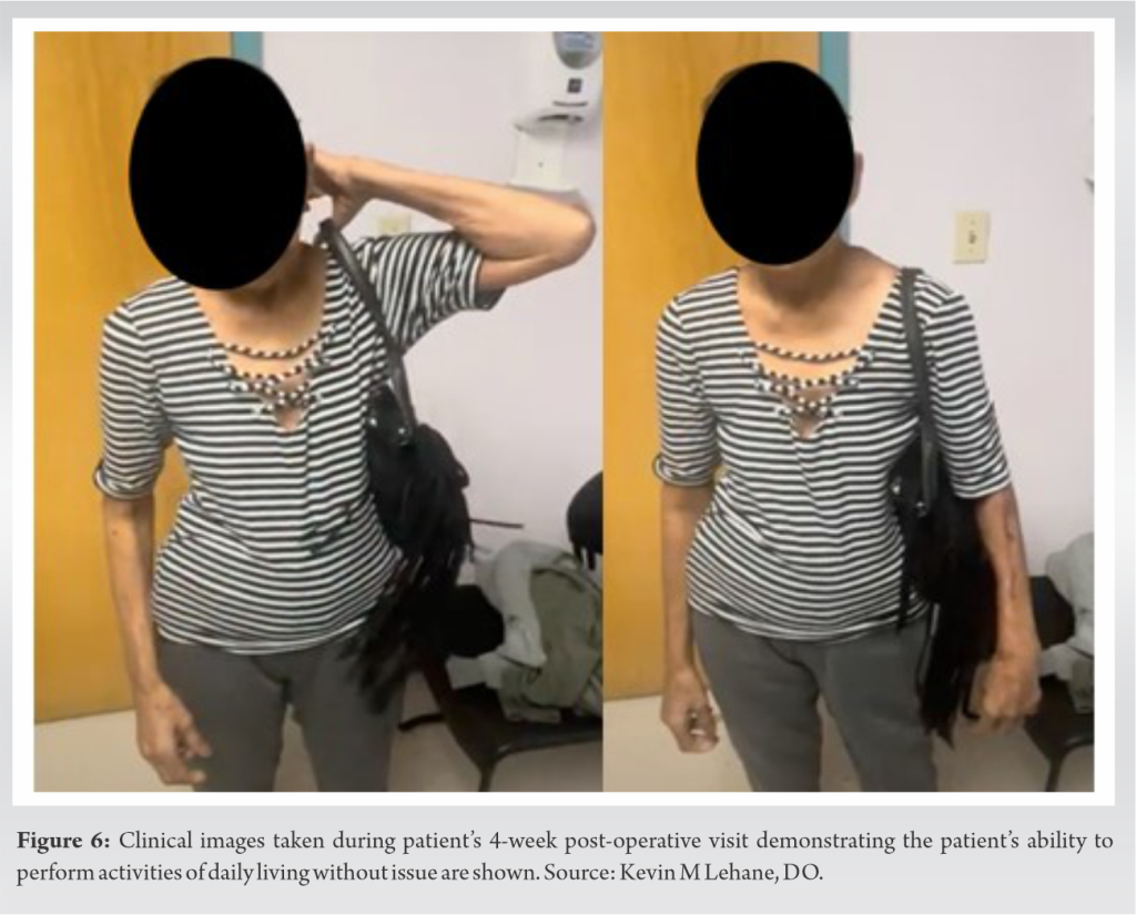 A 65-Year-Old Female with Missed Open Clavicle Fracture and Subsequent ...