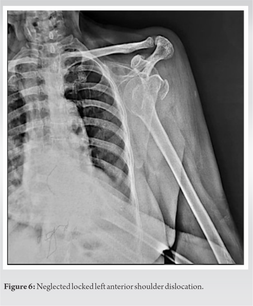 Management of Neglected Locked Anterior Shoulder Dislocation in the ...