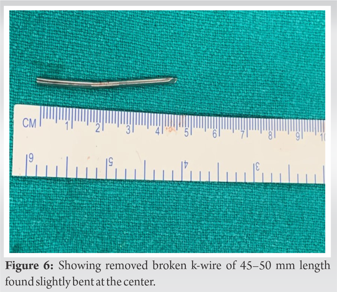 Transforaminal Migration of K-Wire From Clavicle to Cervical Spinal ...
