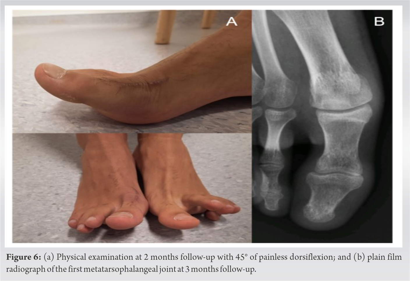 Case Report of an Osteochondral Lesion of the First Metatarsal Head in ...