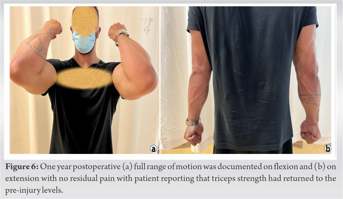 Nontraumatic Triceps Tendon Rupture in a Young Bodybuilder Athlete: A ...