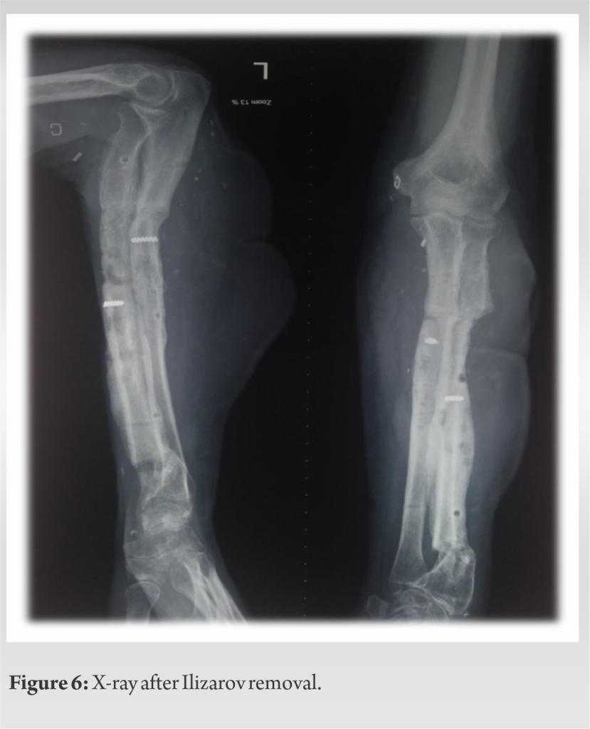 Efficacious Enactment of Ilizarov for Mangled Forearm: A Case Report on ...