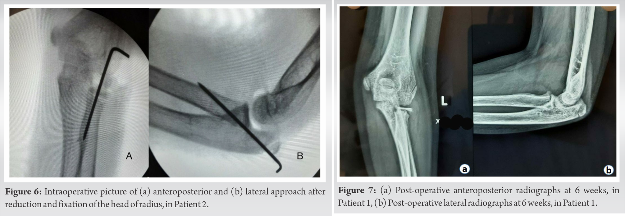 Management and Outcome of Jeffrey Type 2 Fractures in Paediatric ...