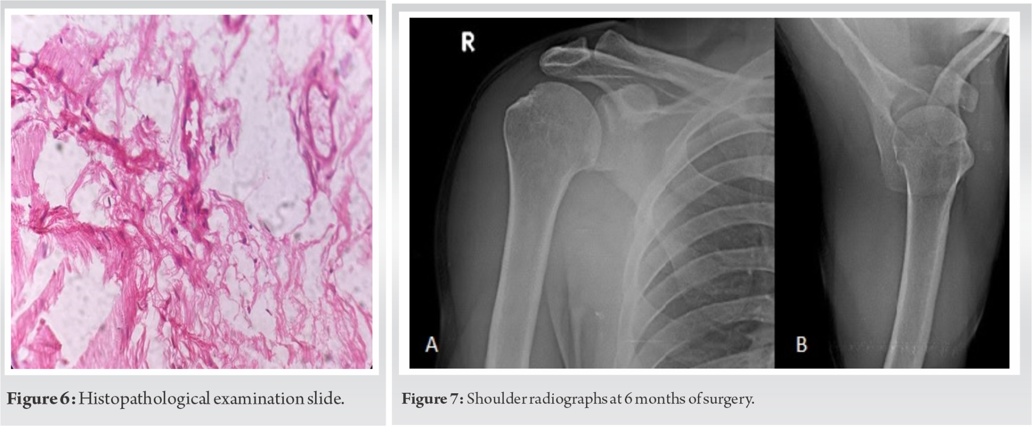 Unusual Case of Long Head of Biceps Tendon Synovial Chondromatosis ...