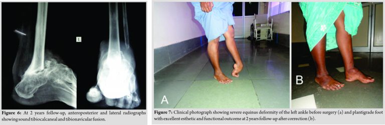 Single-Stage Correction of Severe Rigid Ankle Equinus Deformity by ...