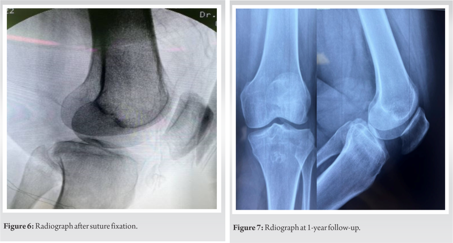 Posterior Cruciate Ligament Avulsion with Posterior Tibial Rim Fracture ...