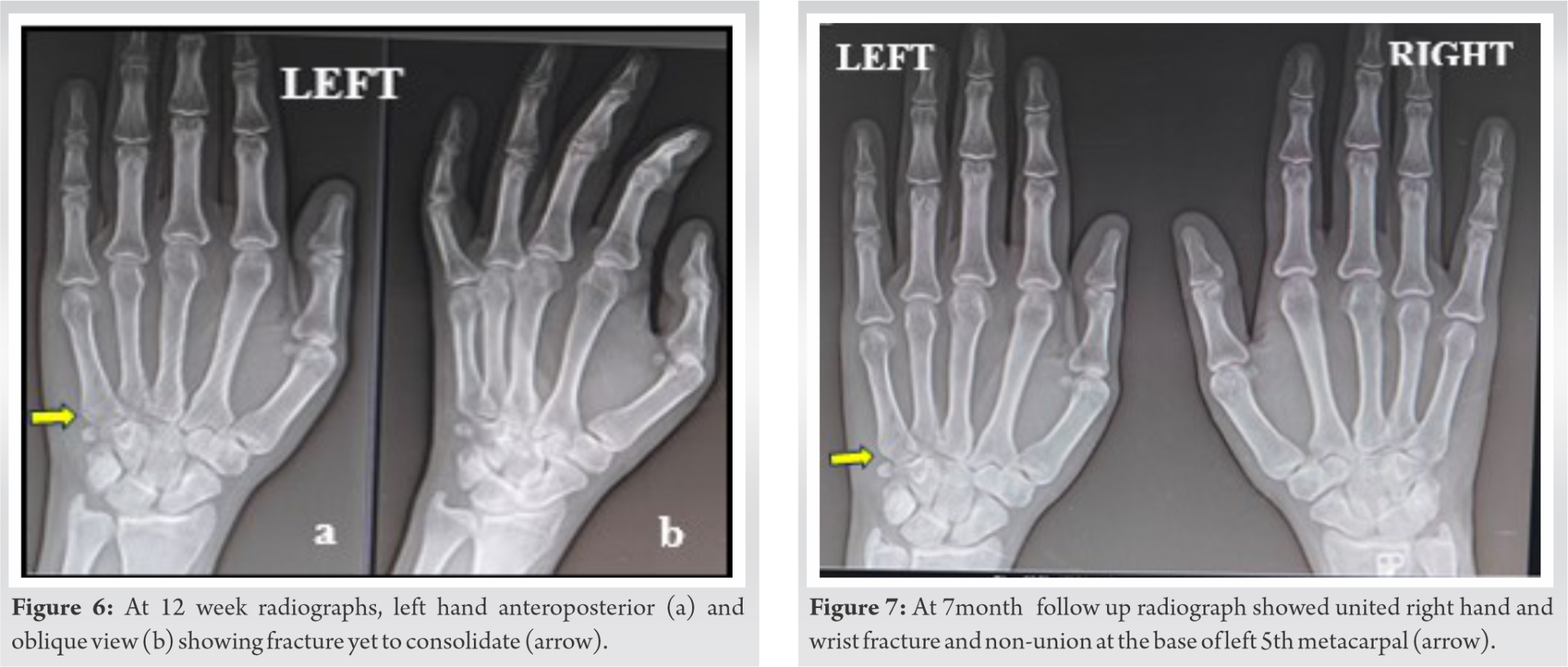 Bilateral Avulsion Fractures of Extensor Carpi Ulnaris: A Case Report ...