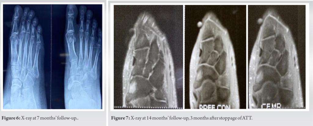 Tubercular Osteomyelitis of Navicular Bone: A Rare Site for Bone ...