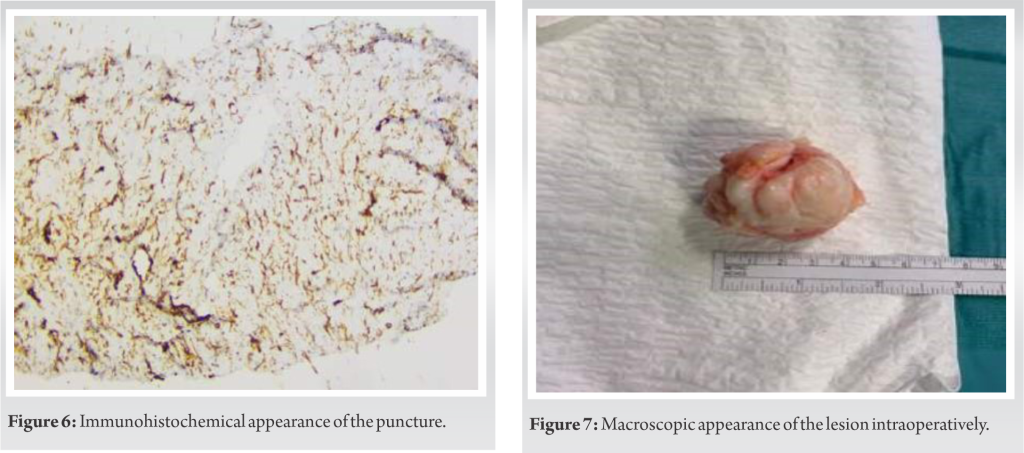 Desmoplastic Fibroblastoma of the Ankle: A Case Report of a Rare ...