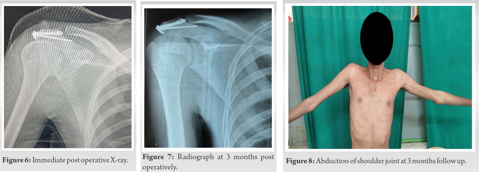Open Displaced Fracture of Acromion with Associated Complete ...