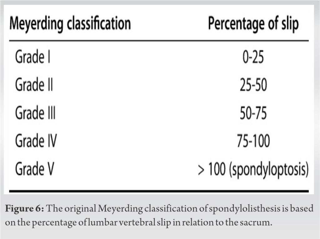 Philosophies and Surgical Techniques for High-Grade Spondylolisthesis ...