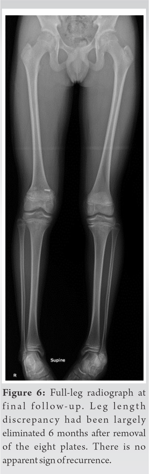 Pediatric Synovial Osteochondromatosis of the Knee with Leg Length ...