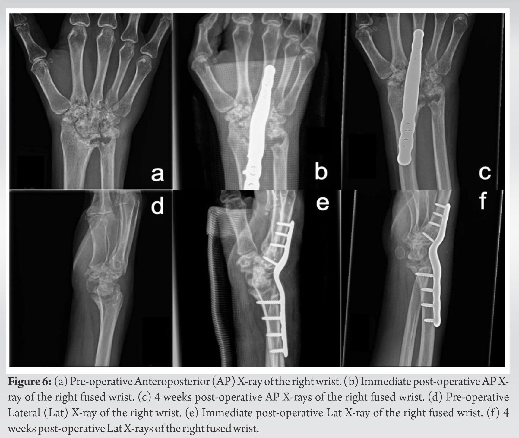 Accessory Extensor Pollicis Longus Spanning the Fourth Dorsal ...