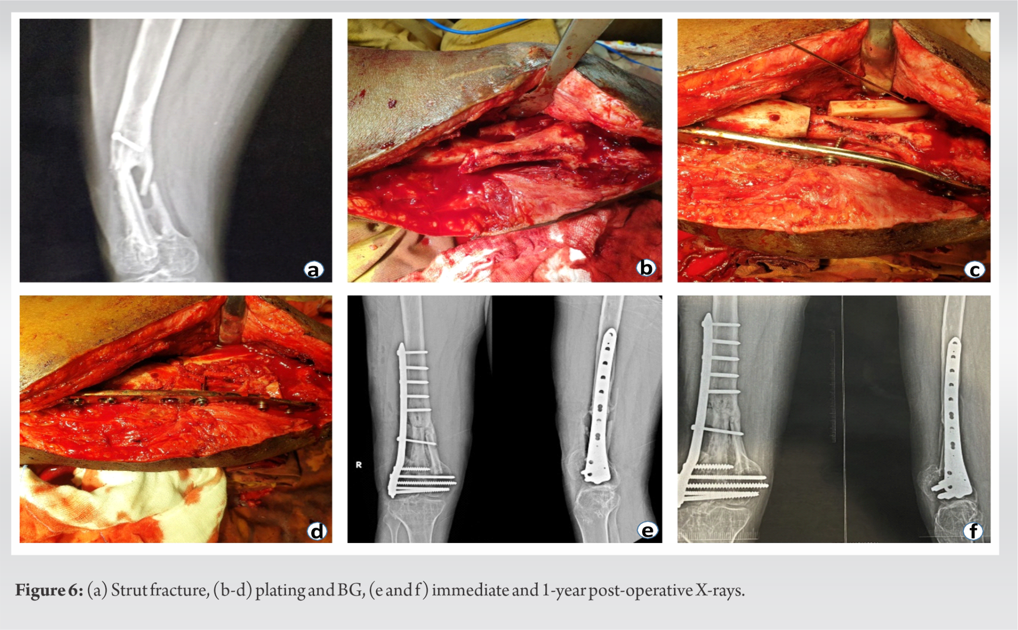 Management of Infected Gap Non-union of Distal Femur with Induced ...