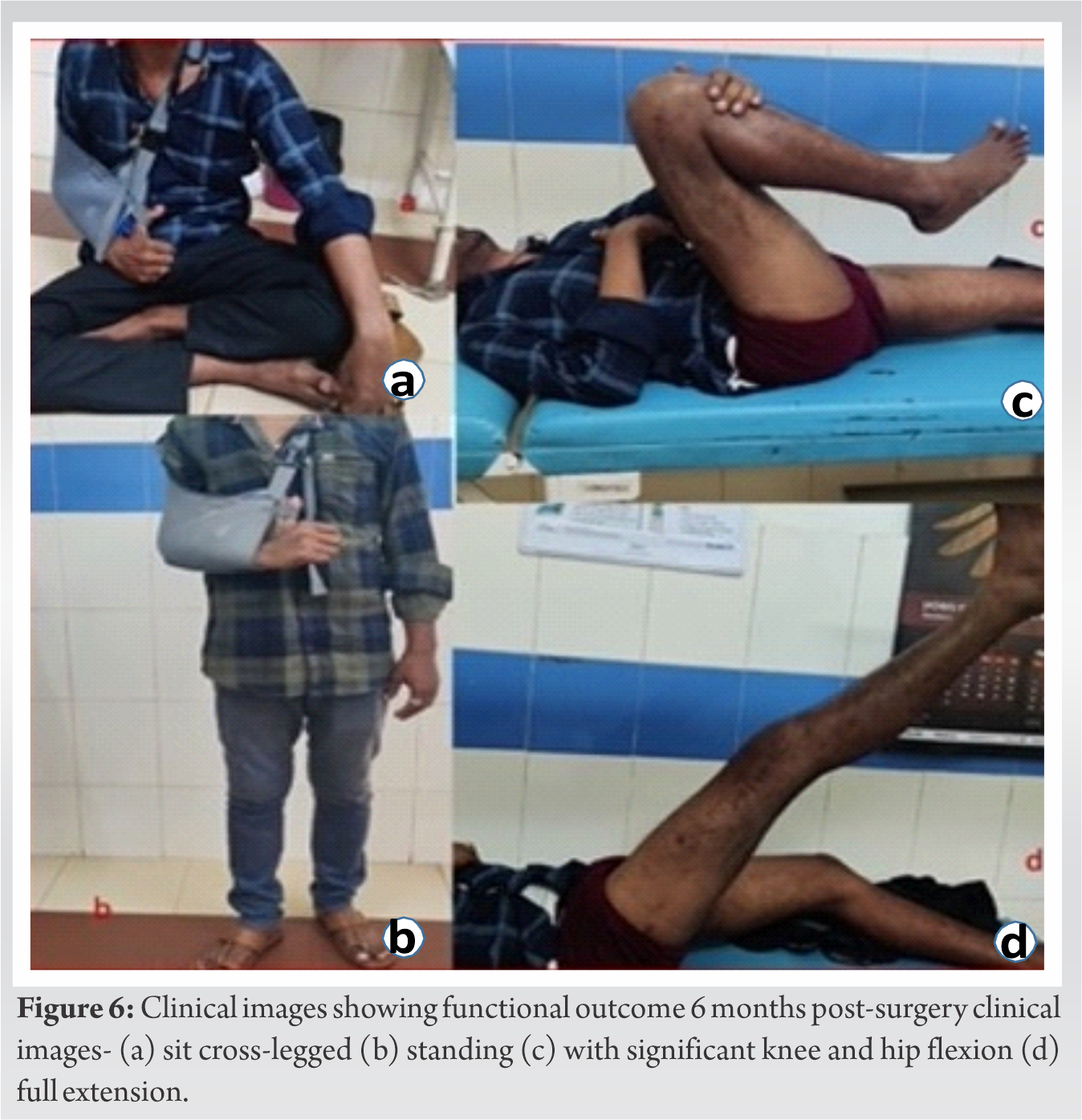 Clinical Outcome of Floating Hip with Irreducible Hip Dislocation and ...