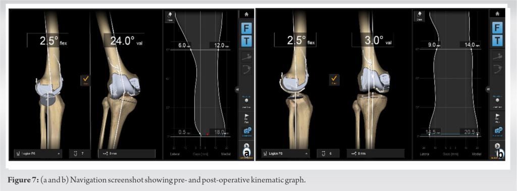 Management of Lateral Femoral Condyle Non-union with Autogenous Bone ...