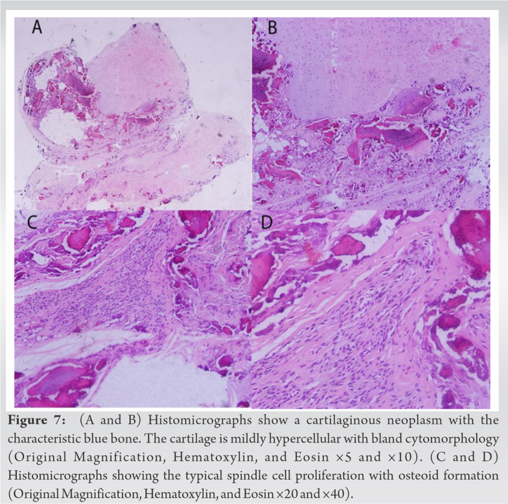 Bizarre Parosteal Osteochondromatous Proliferation (Nora’s Lesion) Of ...