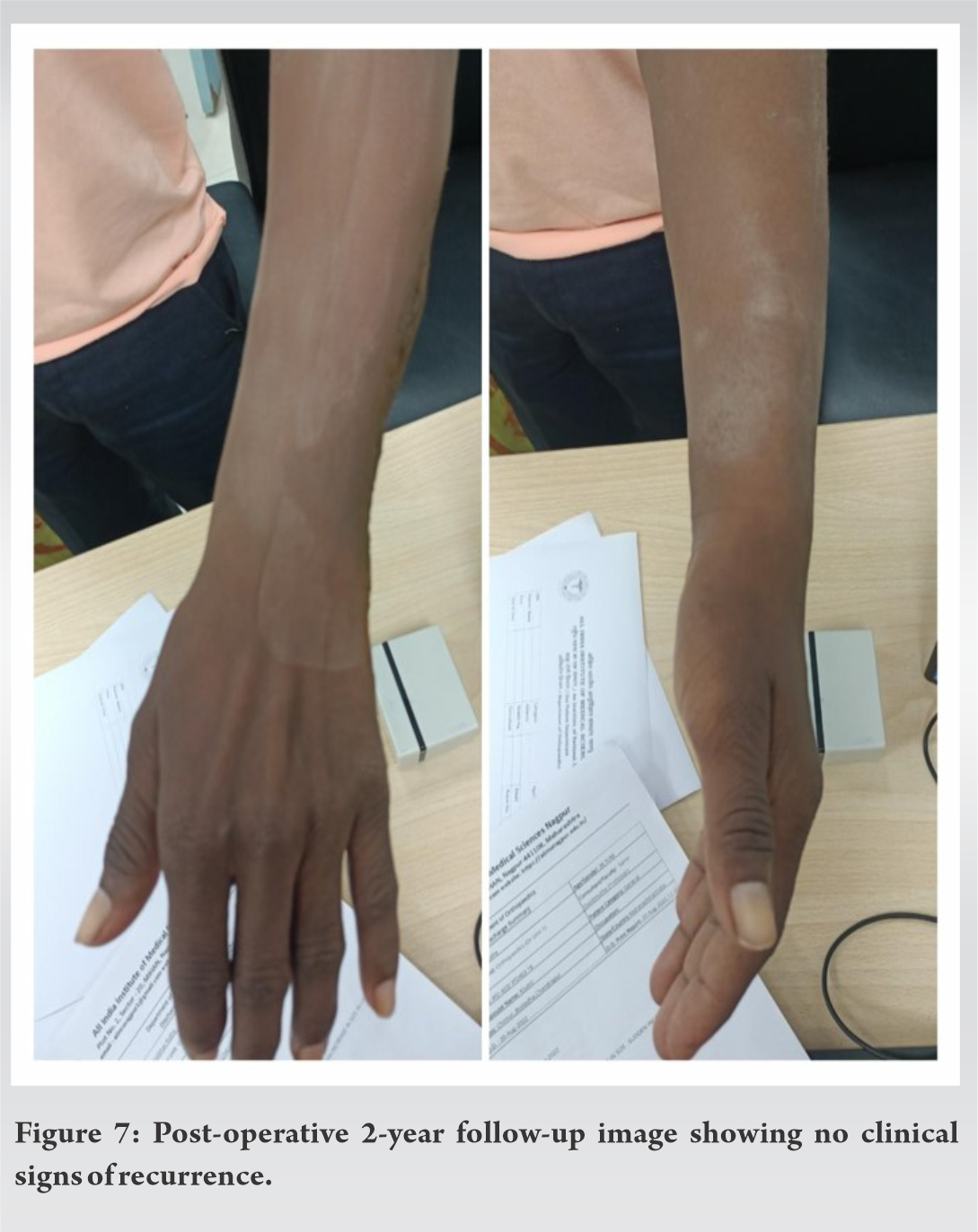 Huge Distal Ulna Giant Cell Tumor Treated with Wide Local Excision and ...