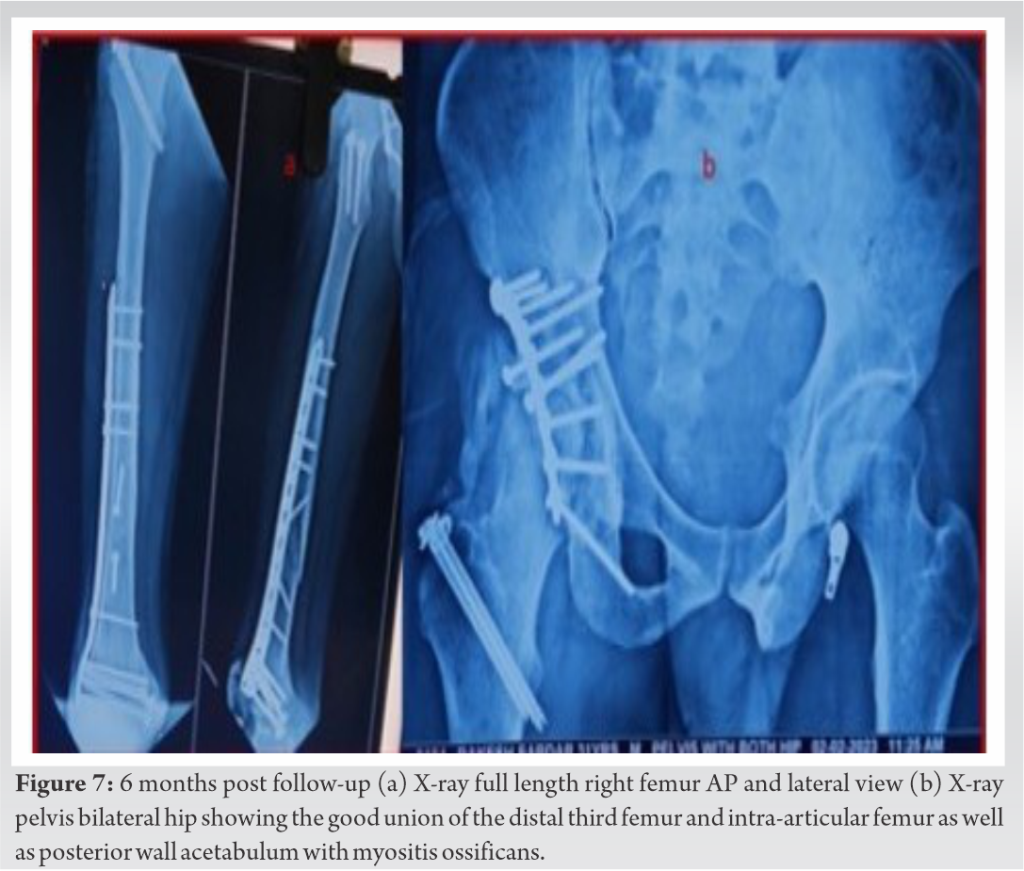 Clinical Outcome of Floating Hip with Irreducible Hip Dislocation and ...
