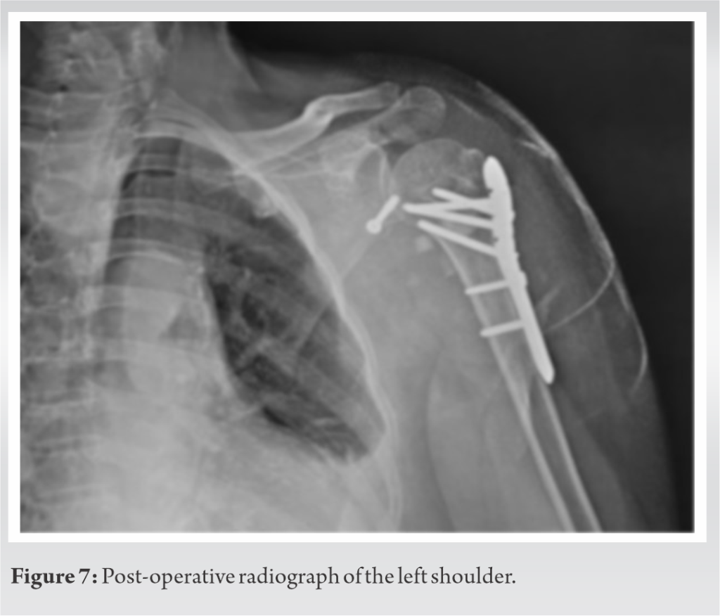 Management of Neglected Locked Anterior Shoulder Dislocation in the ...