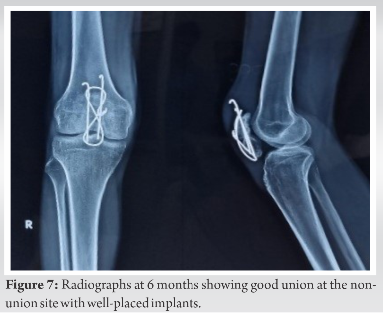 Non-union Patella Fracture – Extensor Mechanism Repair with Quadriceps ...