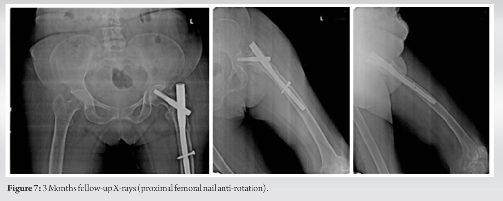 Comparison of functional and radiological outcome of unstable ...