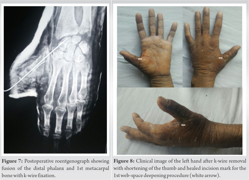 Giant Cell Tumor of Thumb Proximal Phalanx-A Case Report | Journal of ...