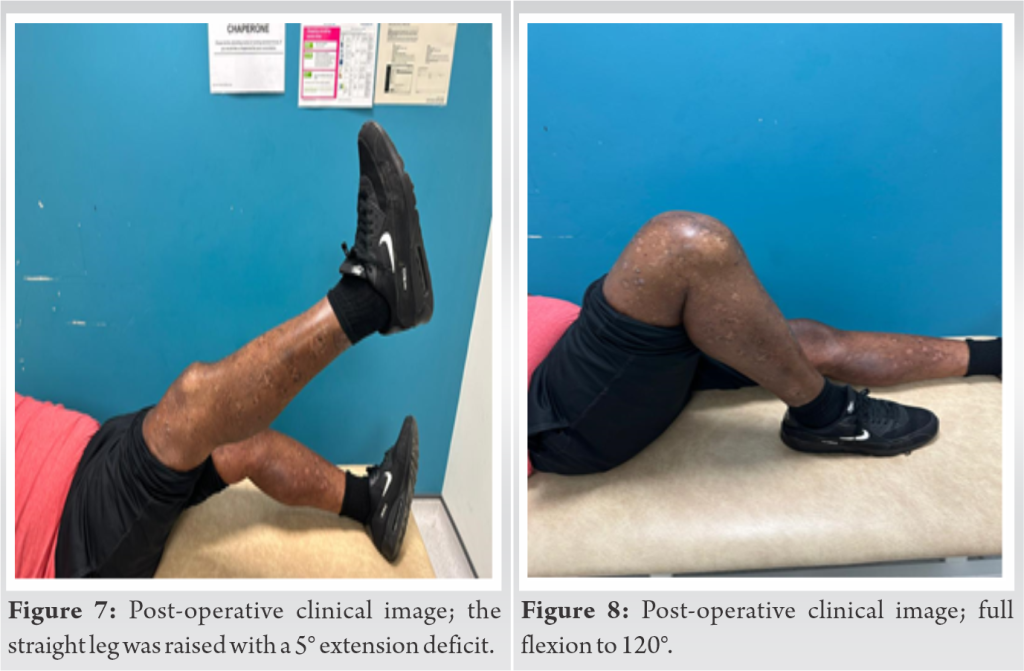 Chronic Quadricep Tendon Rupture Reconstruction with Poly-Tape and ...
