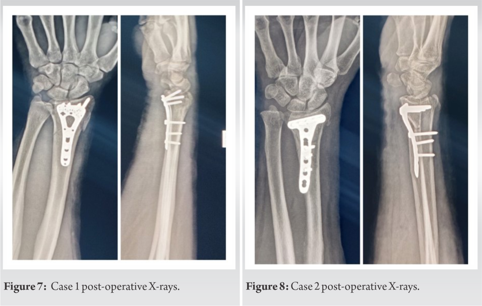 The Efficacy of WALANT Technique in the Management of Distal End Radius ...