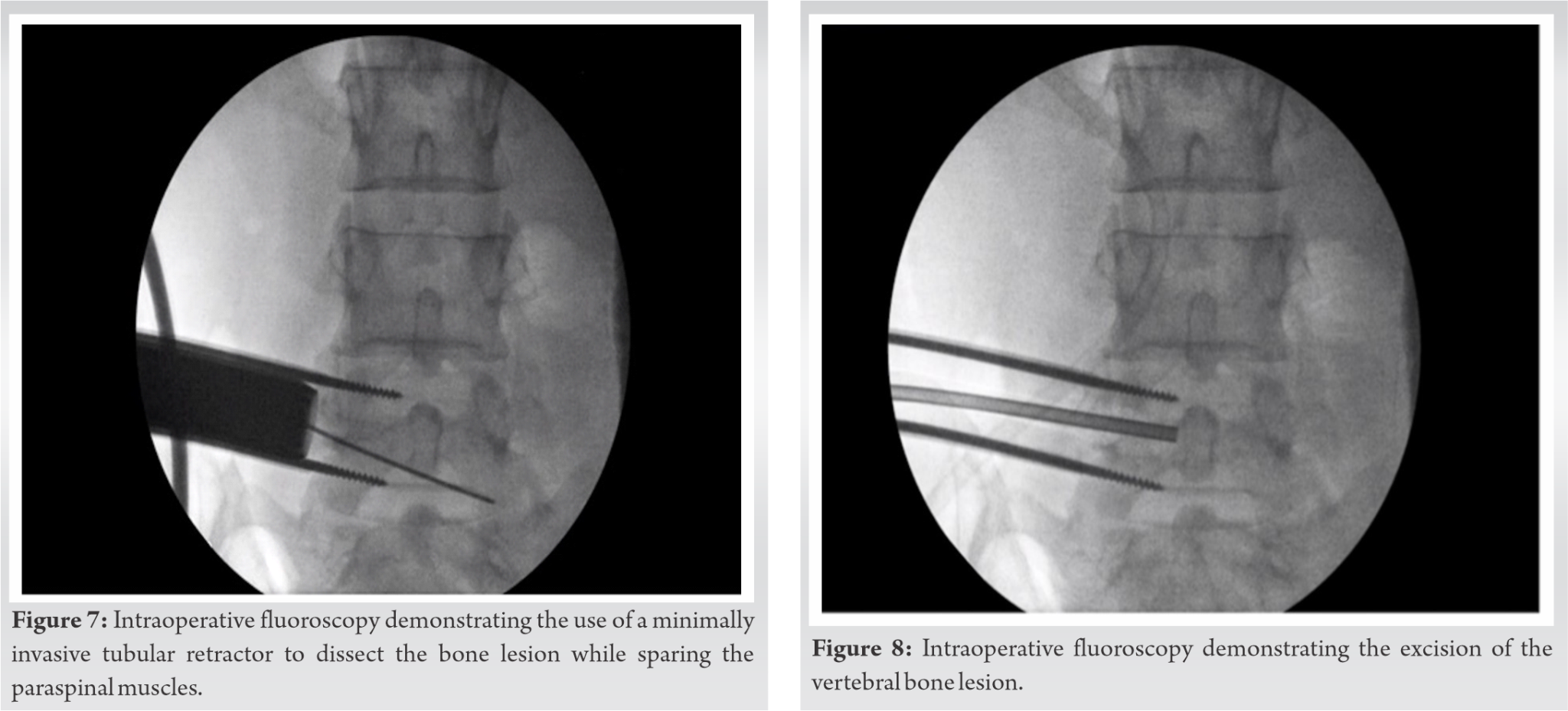 Minimally Invasive Resection of a Lumbar Spine Vertebral Osteoid ...