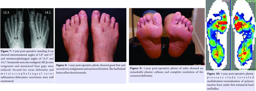 A Case Report of Spontaneous Second Toe Varus Deformity Correction ...