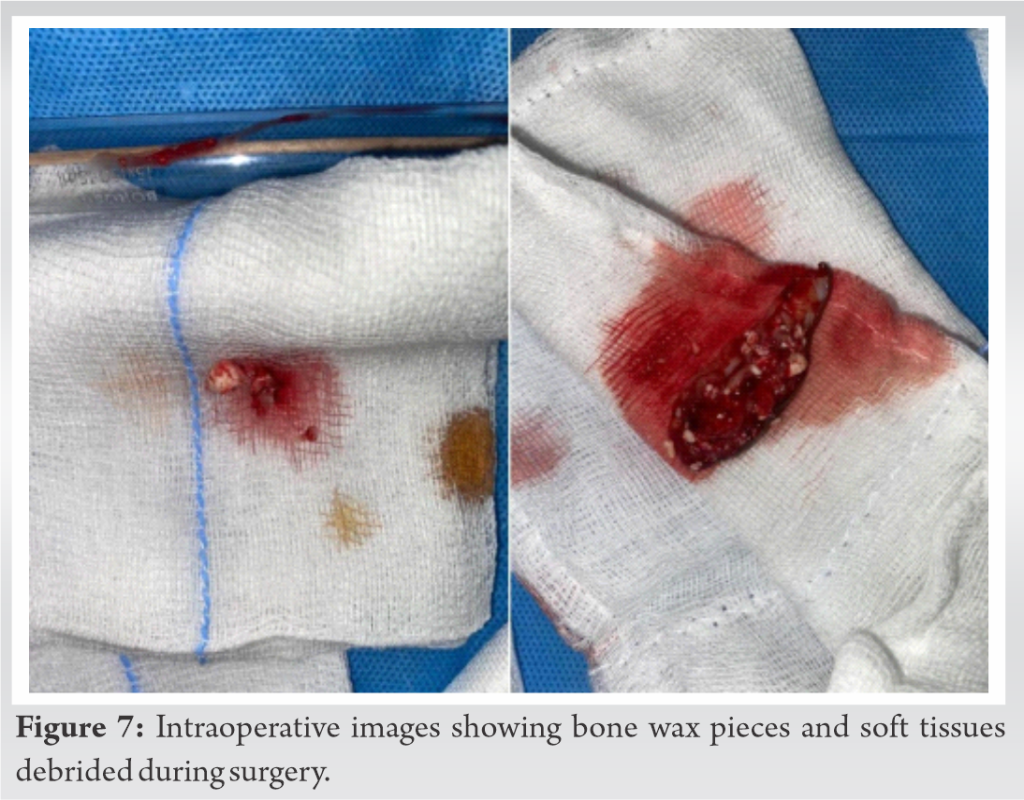 Beyond Hemostasis: Understanding the Risks of Bone Wax in Orthopedic ...