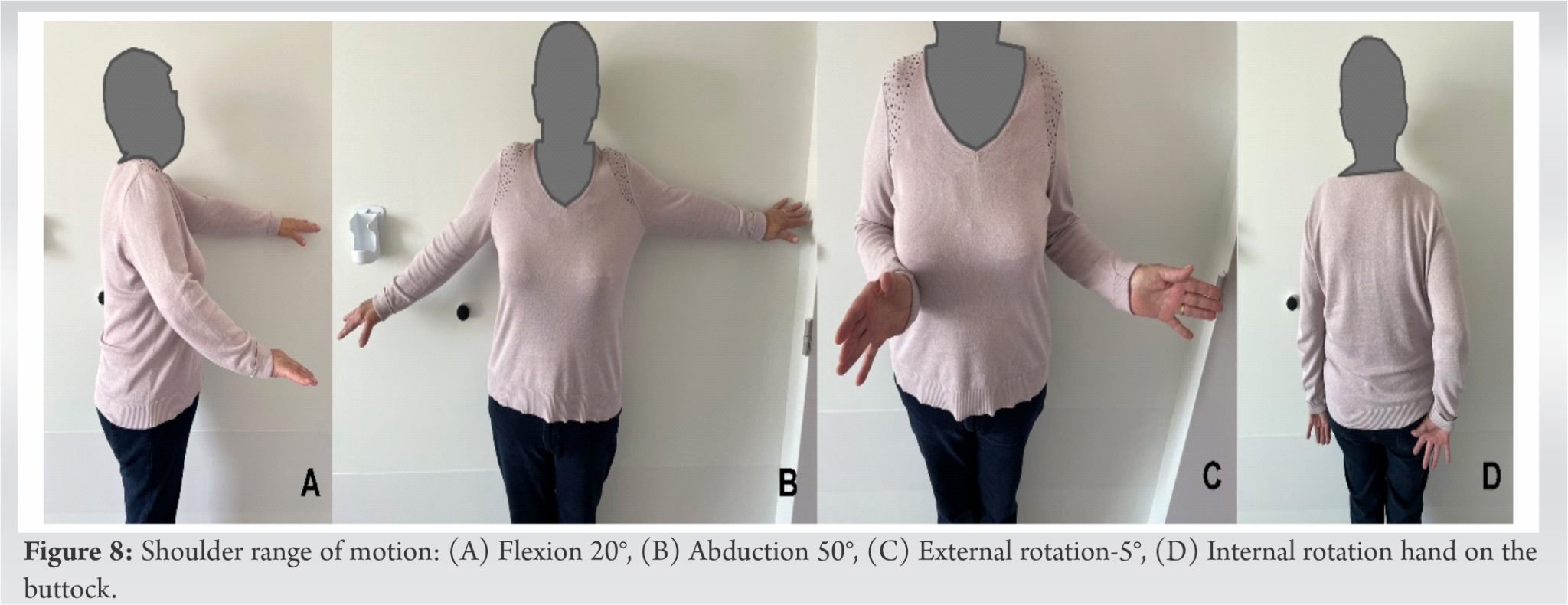 Total Scapular Prosthesis, an Option for the Treatment of Scapular ...