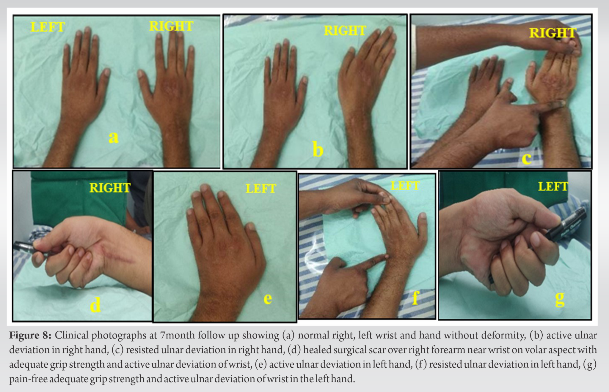 Bilateral Avulsion Fractures of Extensor Carpi Ulnaris: A Case Report ...