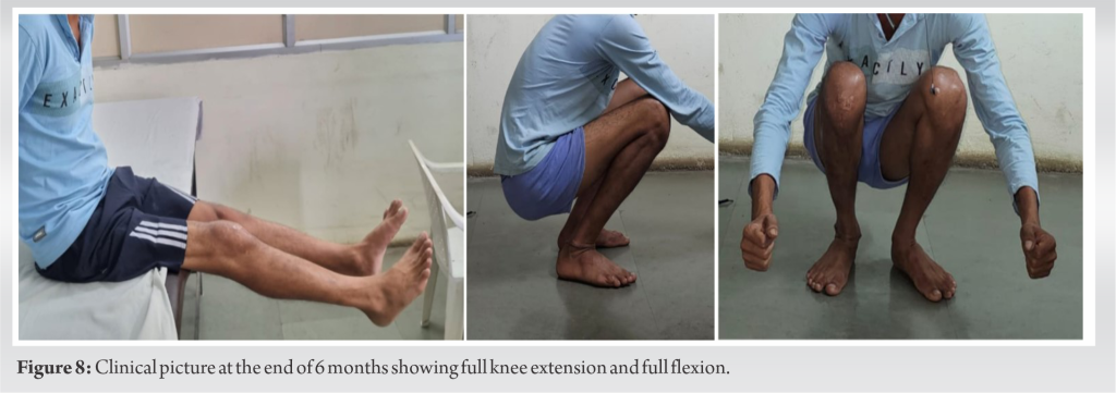 Non-union Patella Fracture – Extensor Mechanism Repair with Quadriceps ...