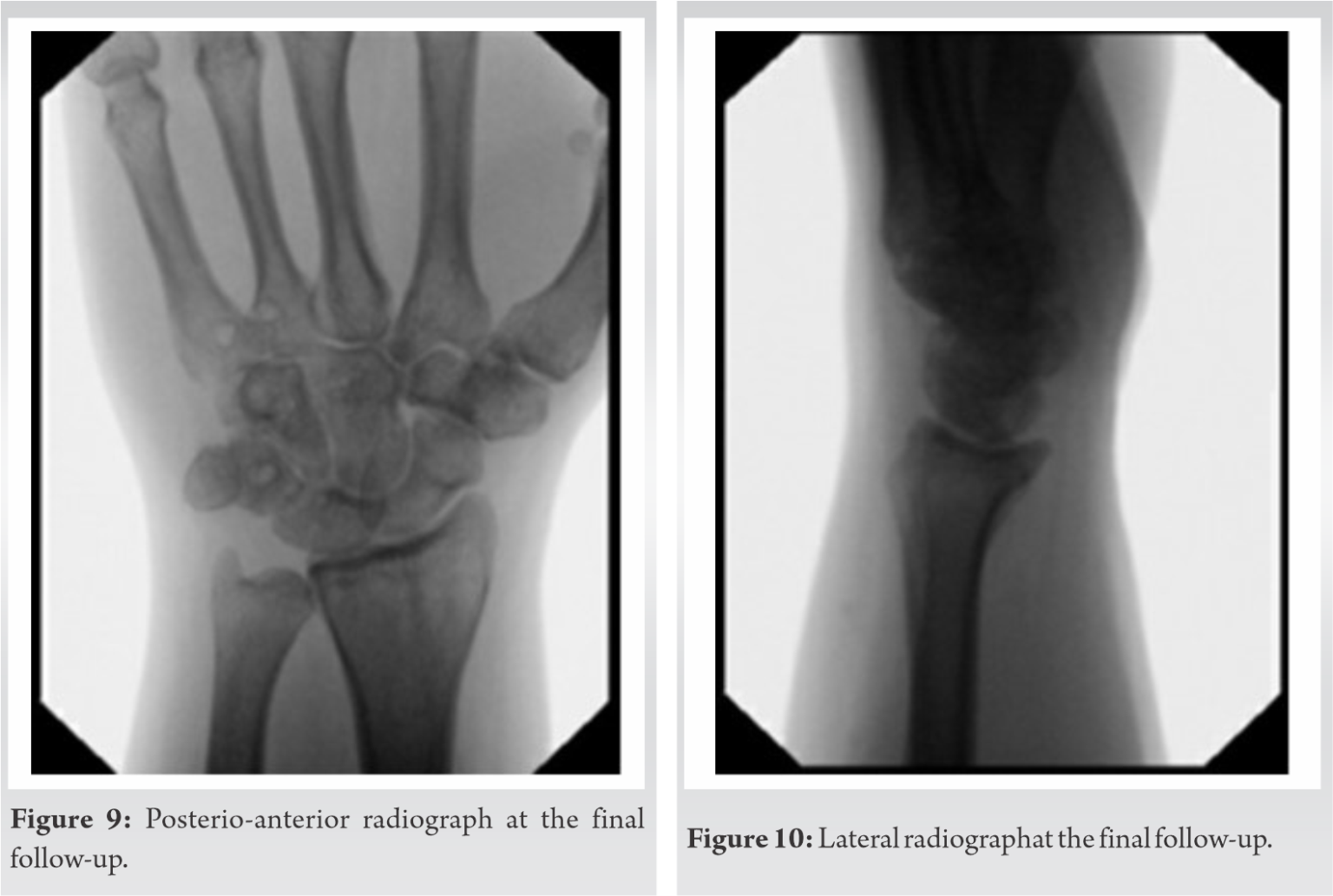 Isolated Hamate Dislocation: A Case Report and Technique Guide | Journal of Orthopaedic Case Reports