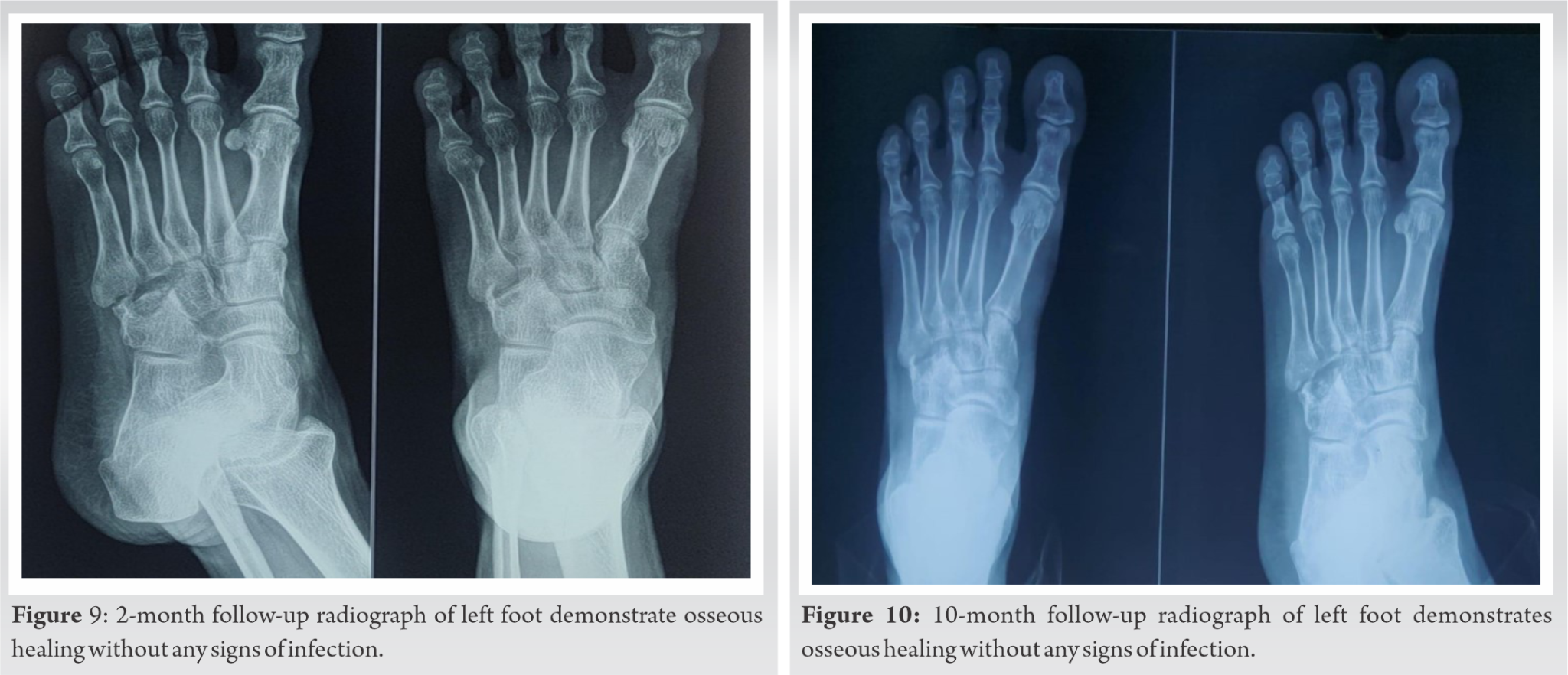 Chronic Tuberculous Osteomyelitis of Cuboid: A Case Report | Journal of ...