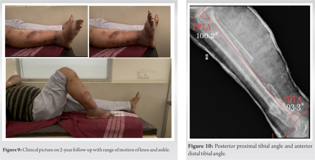 Resistant and Refractory Distal Tibia Non-Union Using an Intramedullary ...