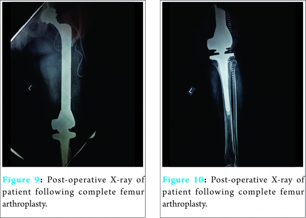 A Case Report of Dual Incision Technique for Total Femur Arthroplasty ...