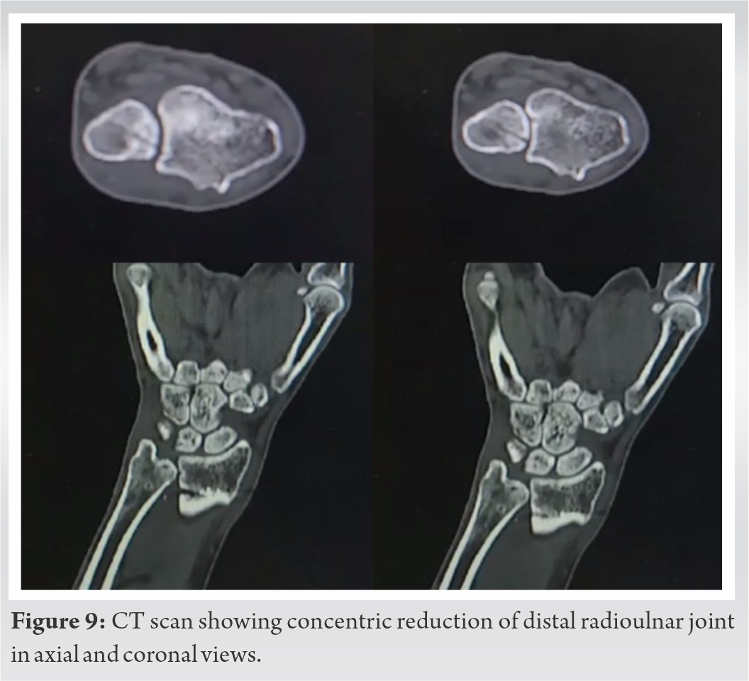 The Novel Technique of Reconstruction of Neglected Distal Radioulnar ...